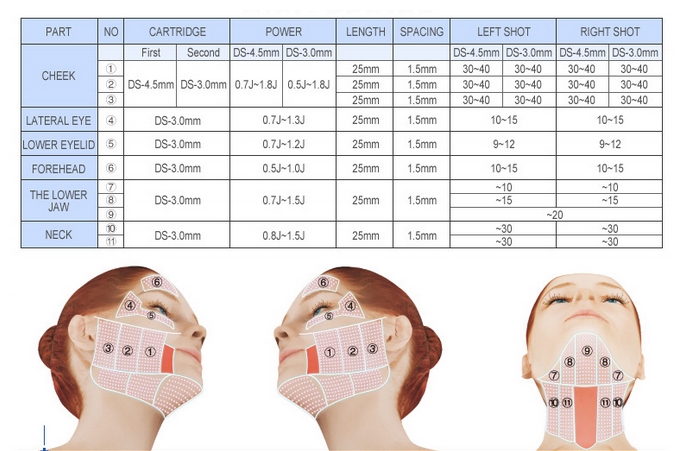 HIFU Operation Method - choicybeauty_Guangzhou, China | Beauty ...