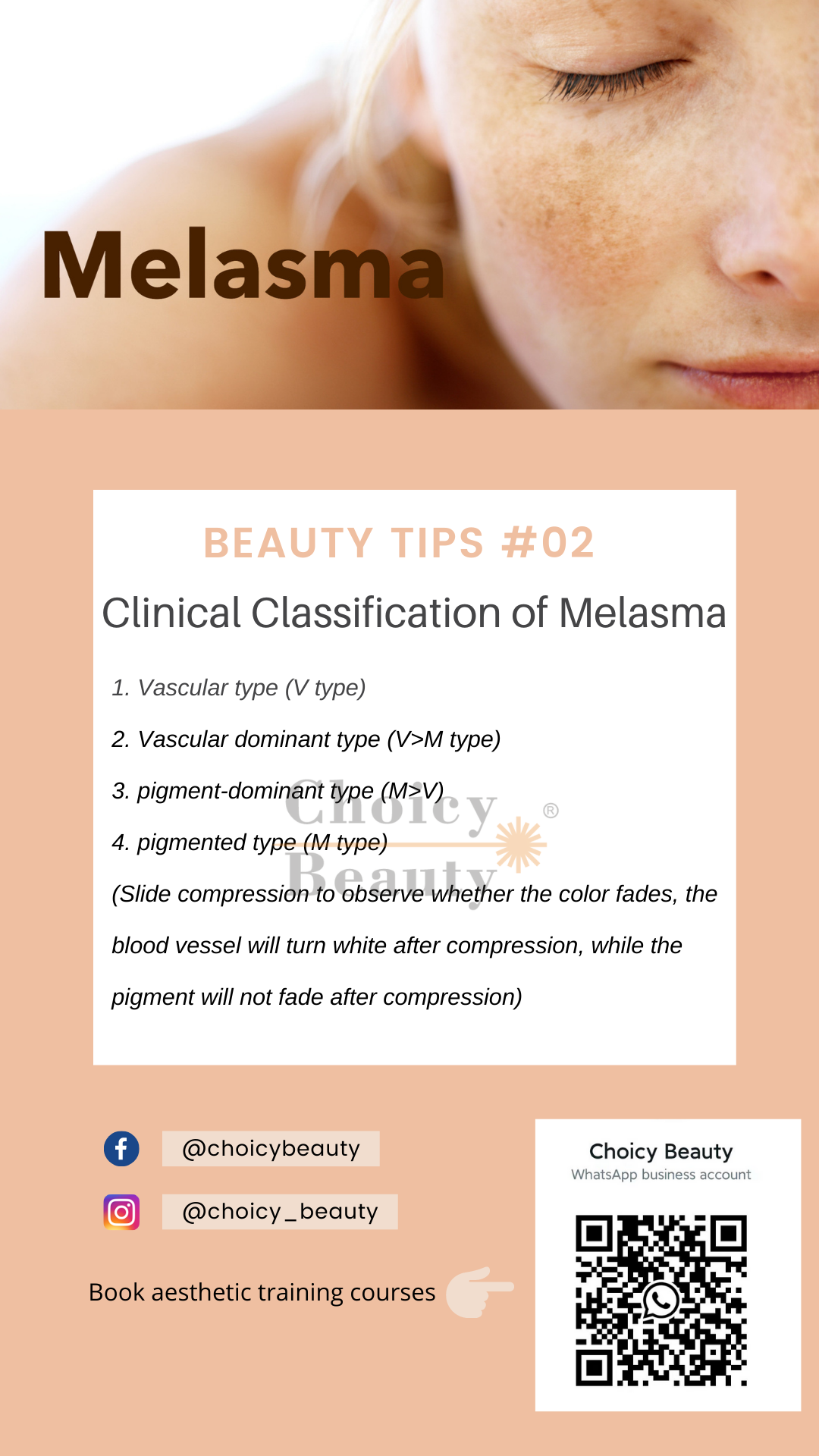 Clinical Classification of Melasma | Choicy Laser
